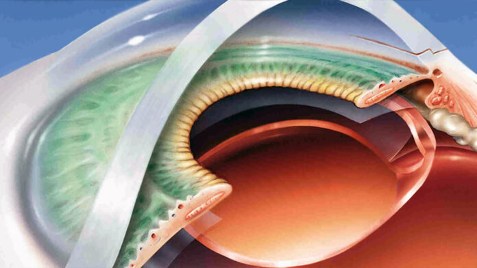 How Successful Is Refractive Lens Exchange? - Green Poison